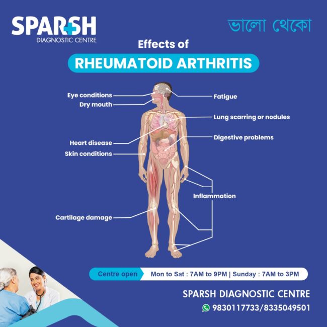 Rheumatoid Arthritis - Sparsh Diagnostic Center
