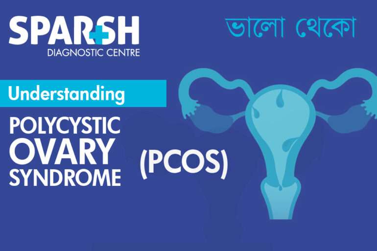 Understanding Polycystic Ovary Syndrome (PCOS) - Sparsh Diagnostic Center