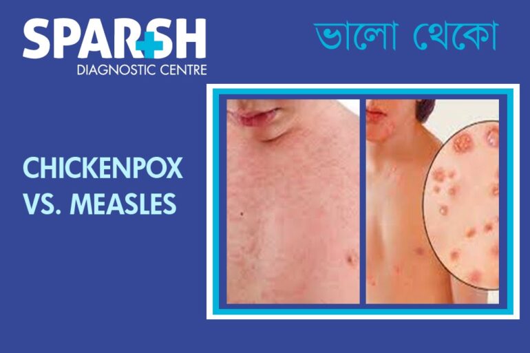 Measles and chickenpox: How are they different? - Sparsh Diagnostic Center