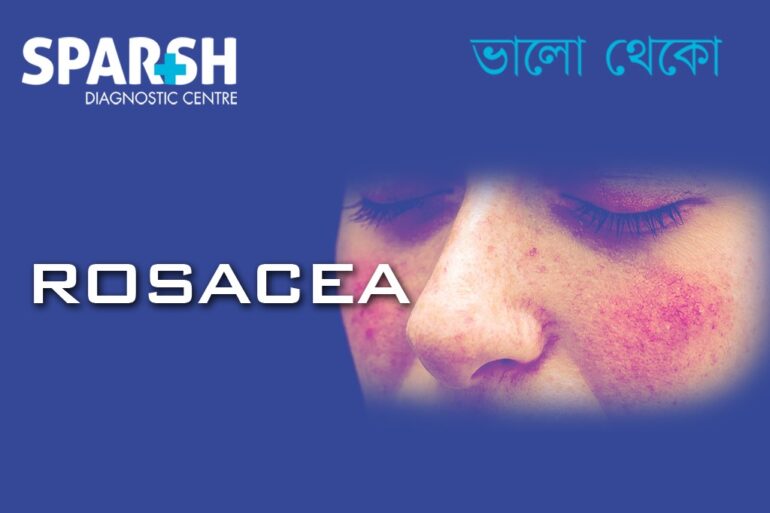 Rosacea - Sparsh Diagnostic Center