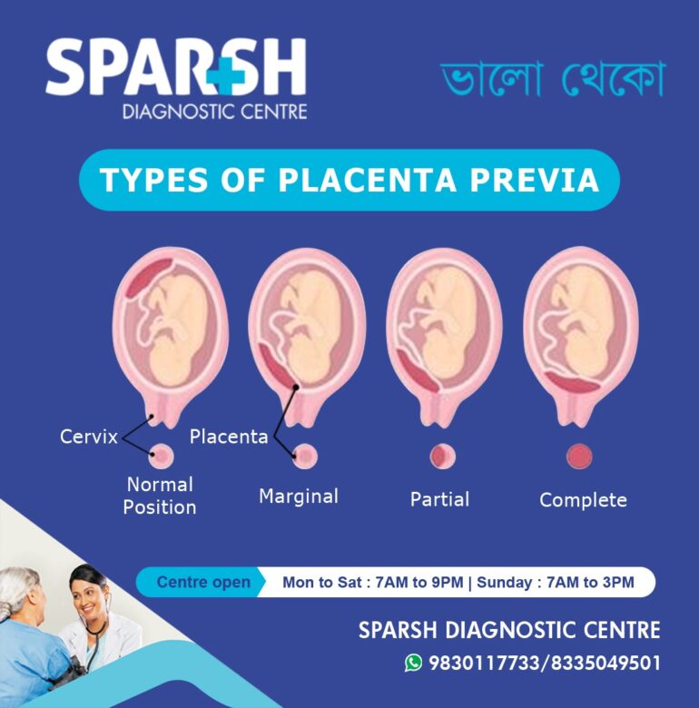 Placenta Previa - Sparsh Diagnostic Center