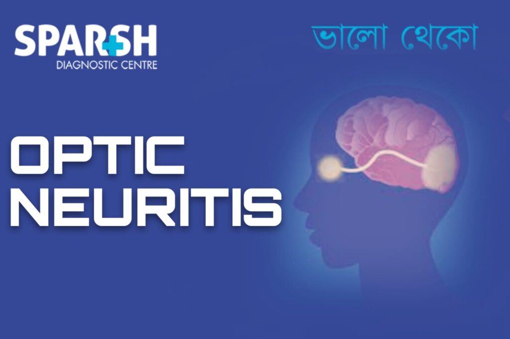 Optic Neuritis - Sparsh Diagnostic Center