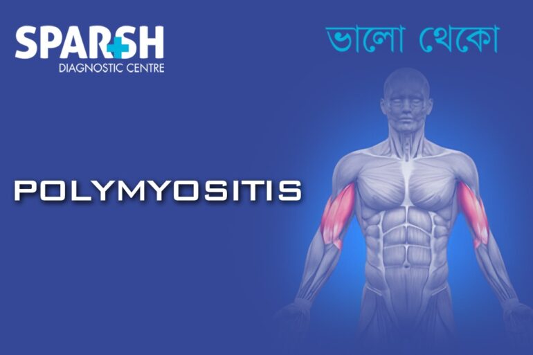 Polymyositis: A Rare Inflammatory Muscle Disease - Sparsh Diagnostic Center