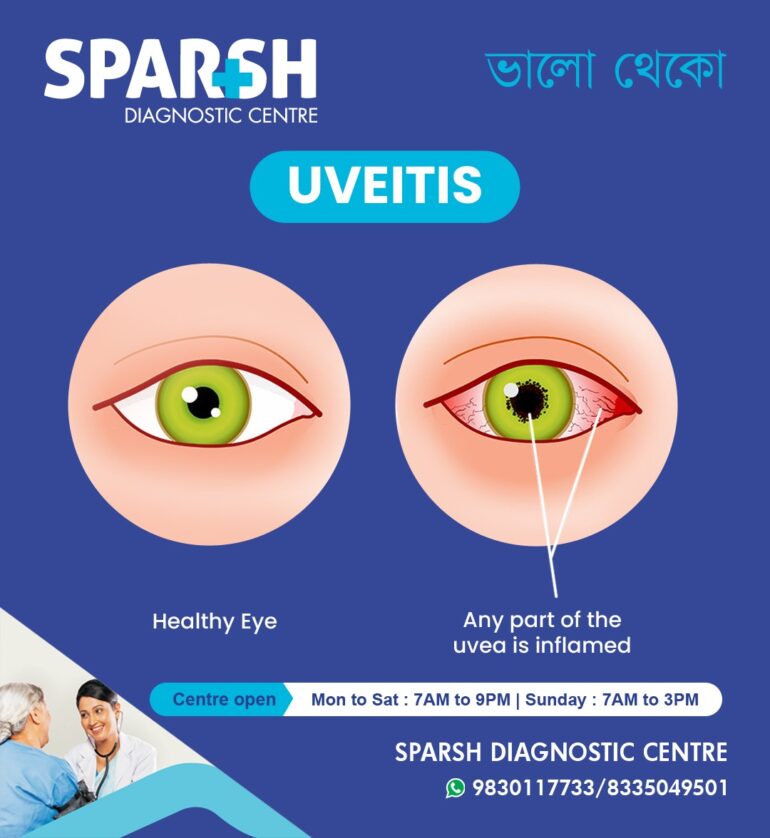 Uveitis: Causes, Symptoms, Diagnosis, and Treatment Options - Sparsh ...