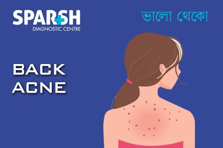 Back Acne: Causes, Treatments, and Prevention Tips - Sparsh Diagnostic ...