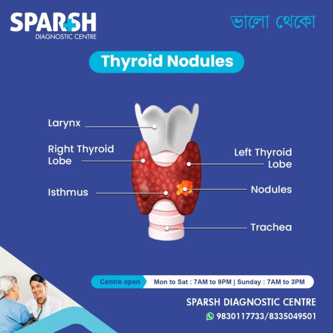Thyroid Nodules - Sparsh Diagnostic Center