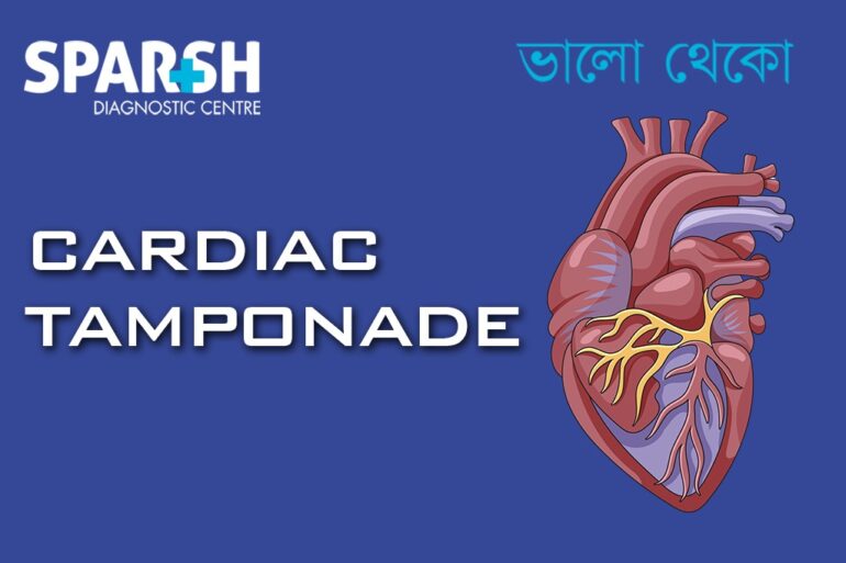 Cardiac Tamponade - Sparsh Diagnostic Center