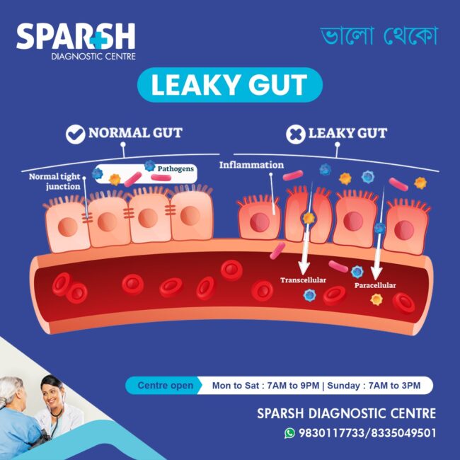 Leaky Gut - Sparsh Diagnostic Center