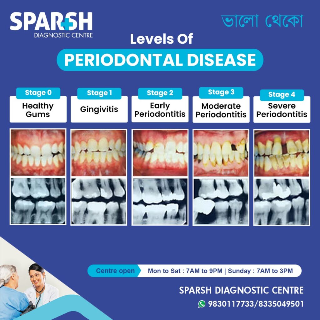 Periodontal Disease - Sparsh Diagnostic Center