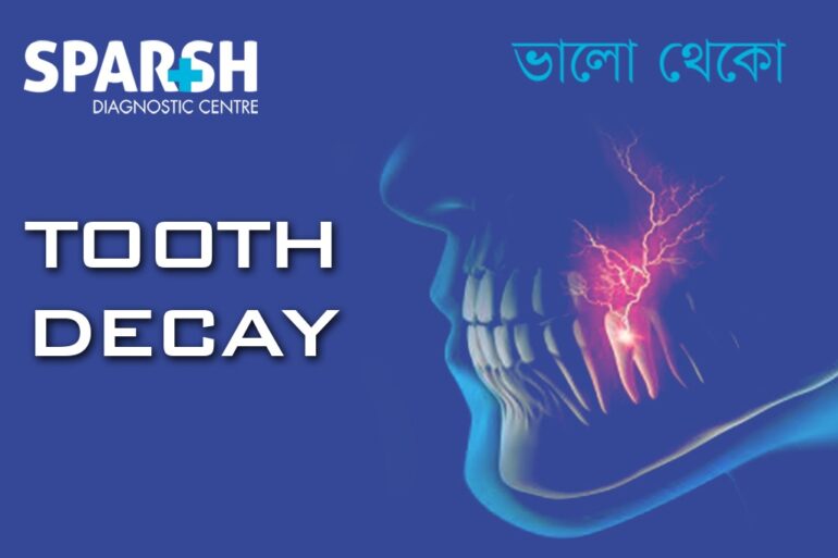 Tooth Decay - Sparsh Diagnostic Center