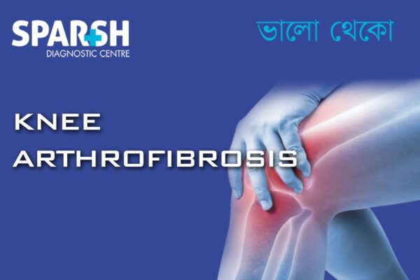 Knee Arthrofibrosis - Sparsh Diagnostic Center