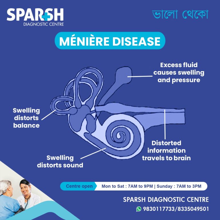 Ménière’s Disease - Sparsh Diagnostic Center