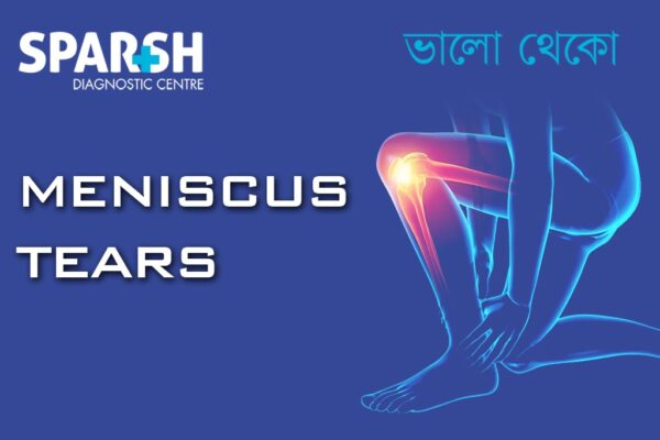 Meniscus Tear - Sparsh Diagnostic Center