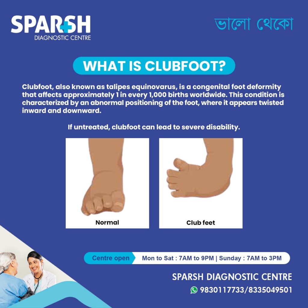 Clubfoot - Sparsh Diagnostic Center