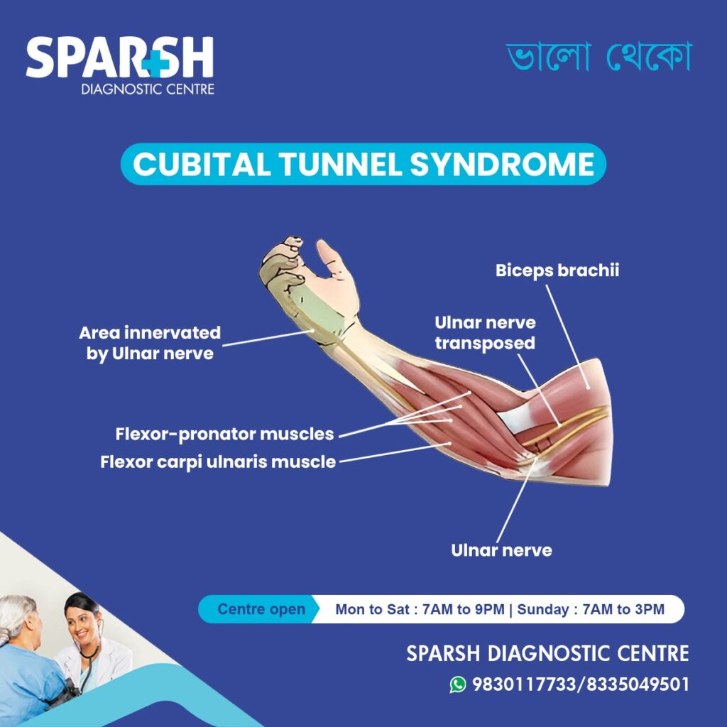 Cubital Tunnel Syndrome - Sparsh Diagnostic Center