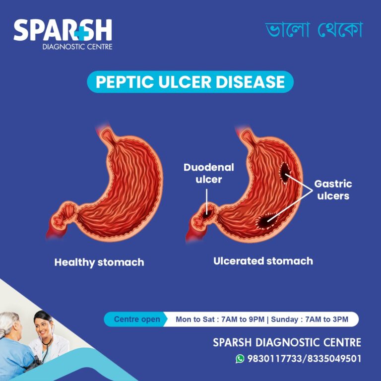 Peptic Ulcer Disease - Sparsh Diagnostic Center