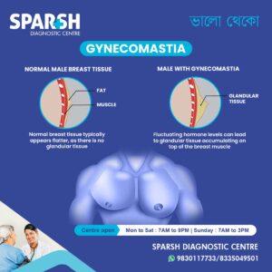 Gynecomastia - Sparsh Diagnostic Center