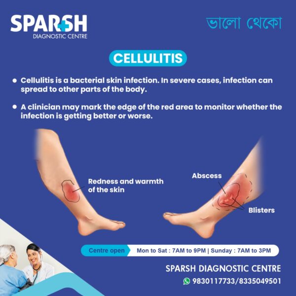 Cellulitis - Sparsh Diagnostic Center