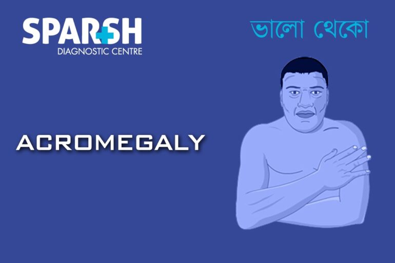 Acromegaly: Causes, Symptoms, Diagnosis, and Treatment - Sparsh ...