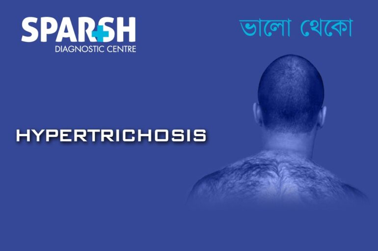 Hypertrichosis: Causes, Symptoms, Diagnosis, and Treatment - Sparsh ...