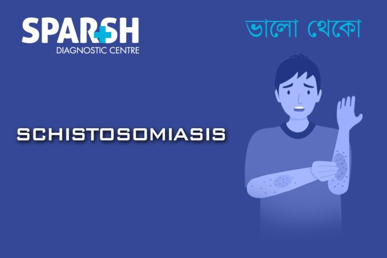 Schistosomiasis: Causes, Symptoms, Diagnosis, and Treatment - Sparsh ...