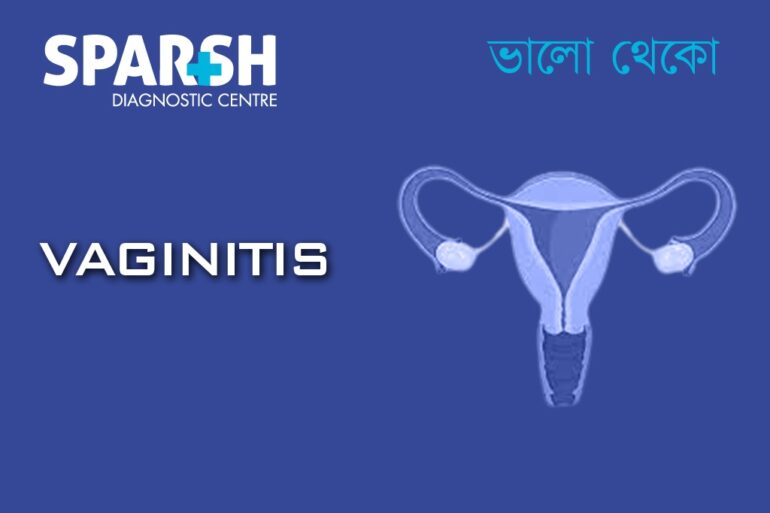 Vaginitis: Causes, Types, Symptoms, Diagnosis, and Treatment - Sparsh ...