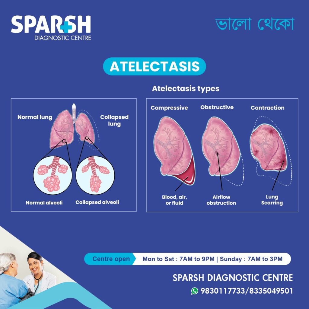 Atelectasis: Causes, Symptoms, Diagnosis, and Treatment - Sparsh ...