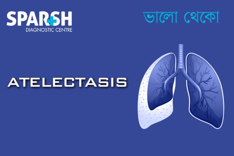 Atelectasis: Causes, Symptoms, Diagnosis, and Treatment - Sparsh ...