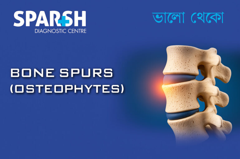 Bone Spurs (Osteophytes): Causes, Symptoms, Diagnosis, and Treatment ...
