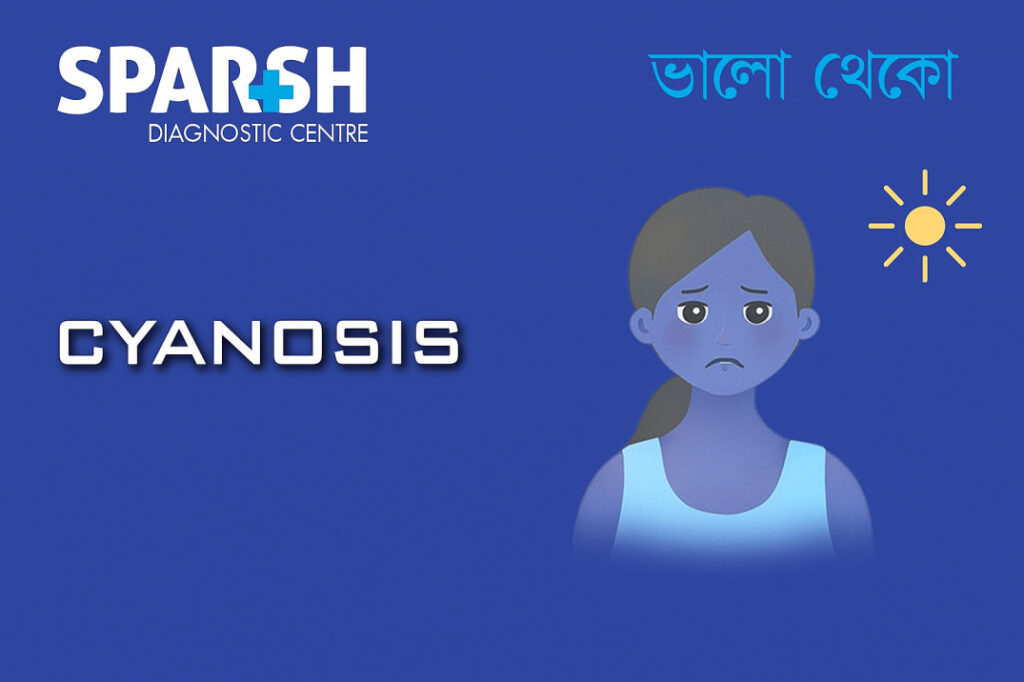 Cyanosis: Causes, Symptoms, Diagnosis, and Treatment - Sparsh ...