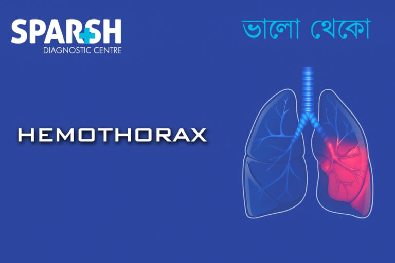 Hemothorax: Causes, Symptoms, Diagnosis, and Treatment - Sparsh ...