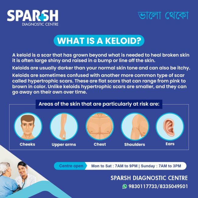 Keloids: Causes, Symptoms, Treatment, and Prevention - Sparsh ...