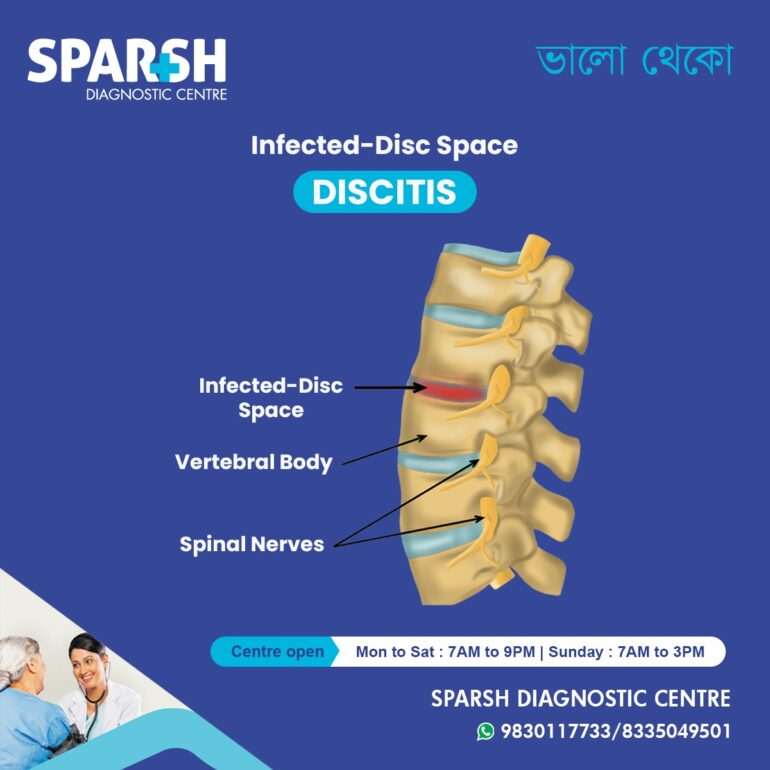 Discitis: Inflammation of the Intervertebral Disc - Sparsh Diagnostic ...