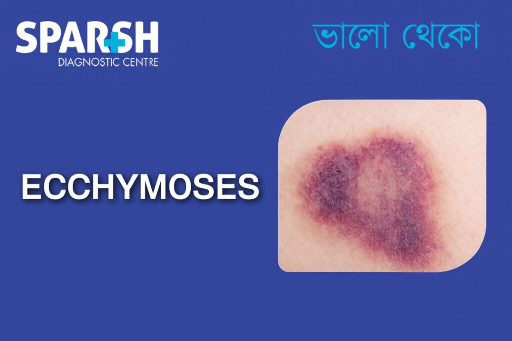 Ecchymoses: Causes, Symptoms, Diagnosis, Treatment & Prevention ...