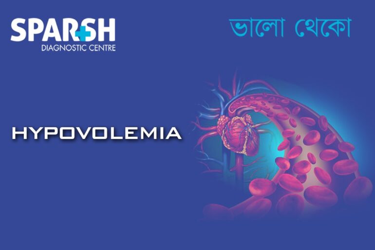 Hypovolemia: Causes, Symptoms, Diagnosis & Treatment – A Complete Guide ...