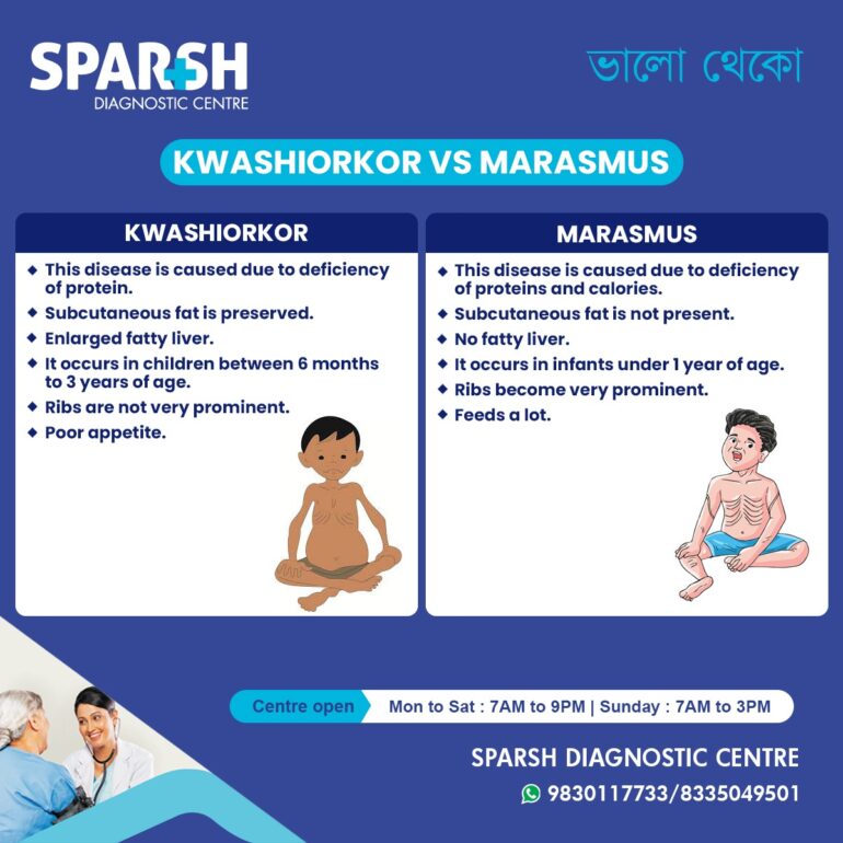 Difference Between Kwashiorkor and Marasmus: A Complete Guide to Protein-Energy Malnutrition ...