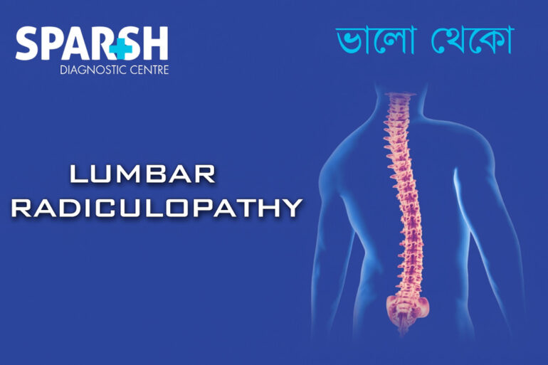 Lumbar Radiculopathy: Causes, Symptoms, Diagnosis, and Treatment ...