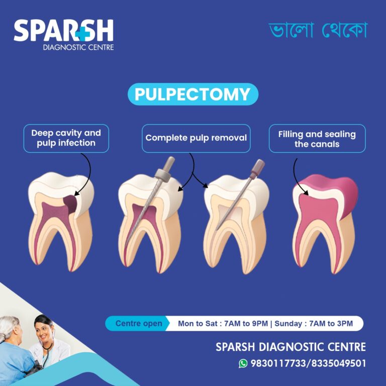Pulpectomy: Procedure, Benefits, Recovery & Complete Guide - Sparsh ...