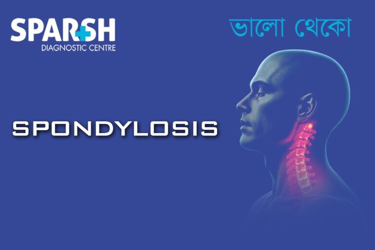 Spondylosis: Causes, Symptoms, Diagnosis & Effective Treatment Options ...