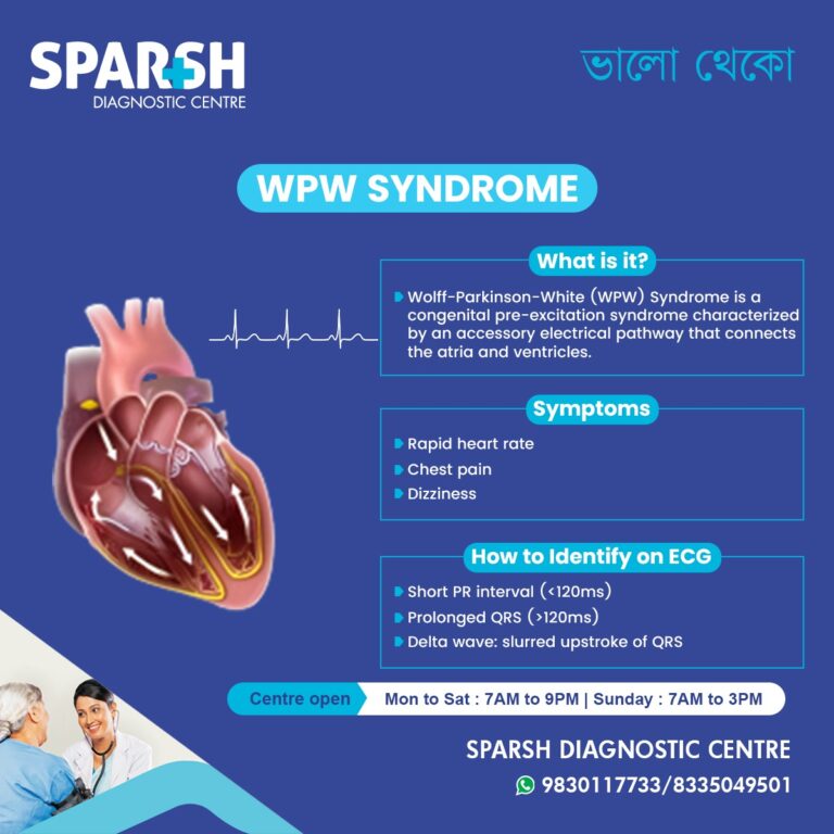 Wolff–Parkinson–White (WPW) Syndrome: Causes, Symptoms, Diagnosis, and ...