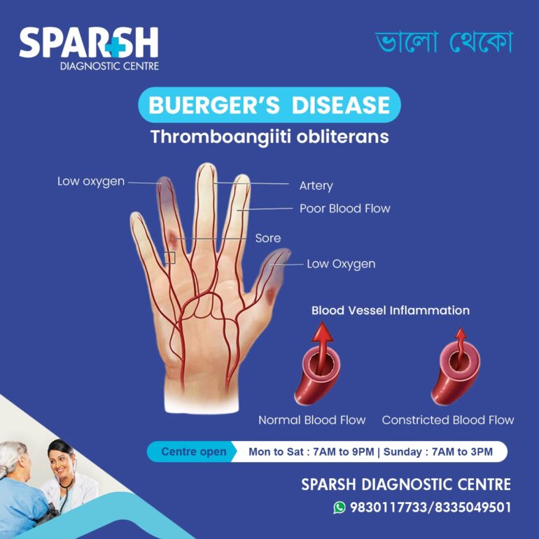 Buerger’s Disease (Thromboangiitis Obliterans): Causes, Symptoms ...