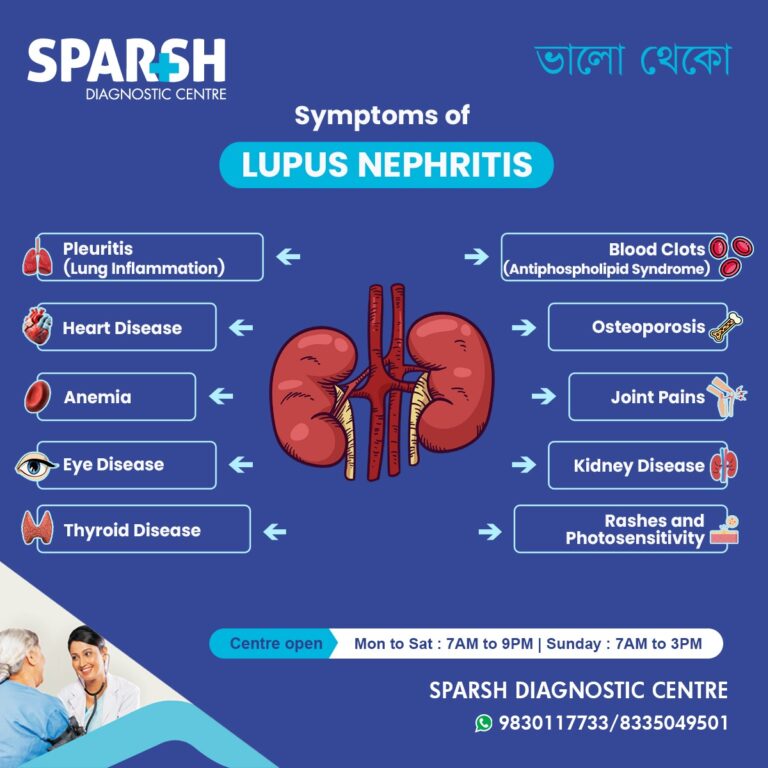 Lupus Nephritis: Causes, Symptoms, Diagnosis, Treatment, and Long-Term ...
