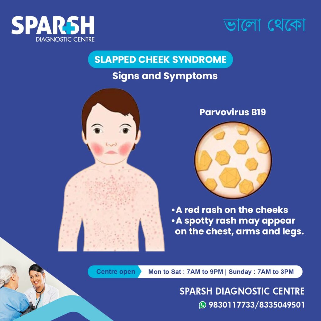 Slapped Cheek Syndrome: Causes, Symptoms, Treatment, and When to Worry ...