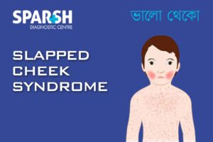 Slapped Cheek Syndrome: Causes, Symptoms, Treatment, and When to Worry ...