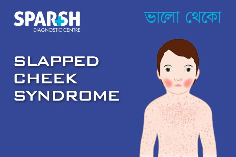 Slapped Cheek Syndrome: Causes, Symptoms, Treatment, and When to Worry ...