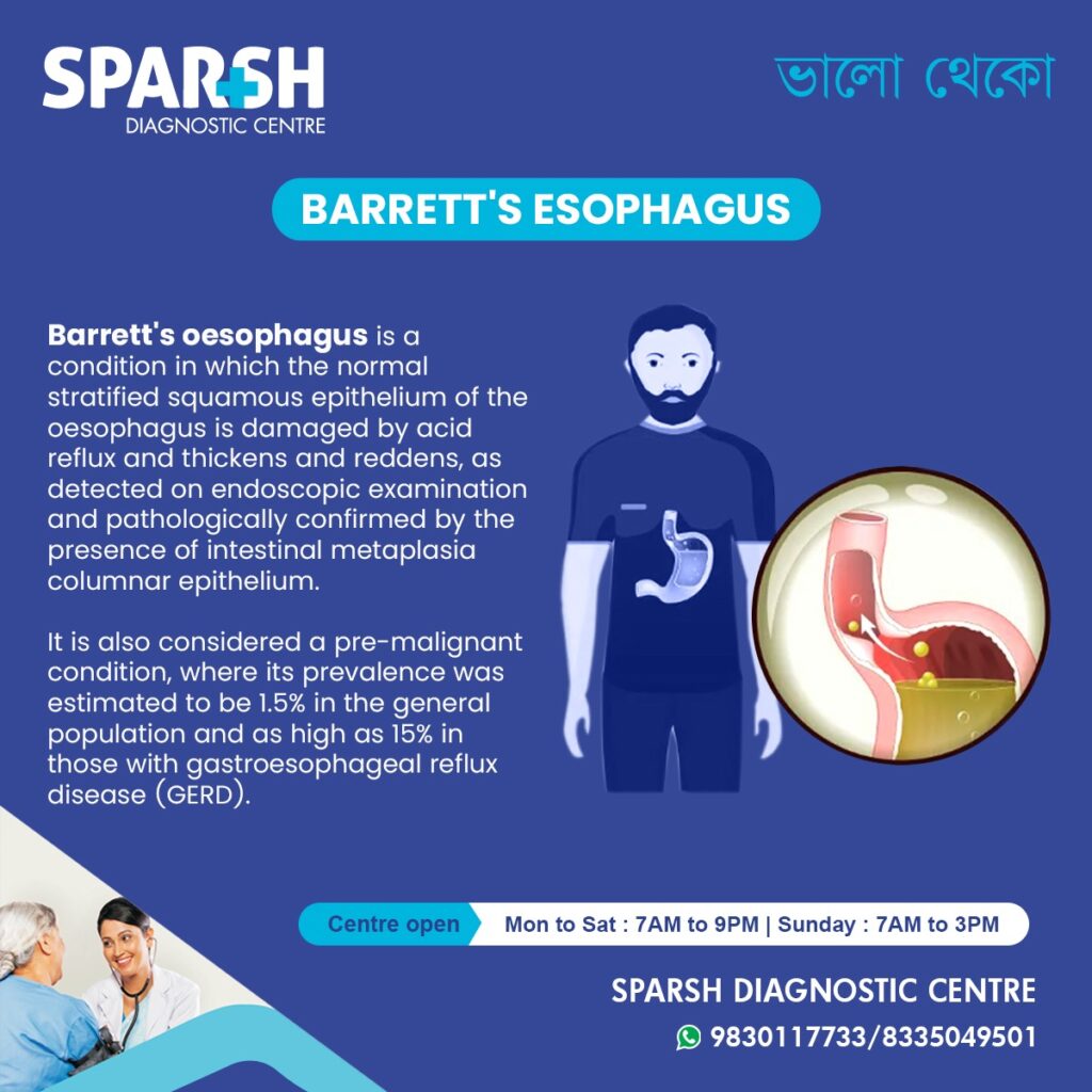 Barrett’s Esophagus: Causes, Symptoms, Diagnosis, and Treatment ...