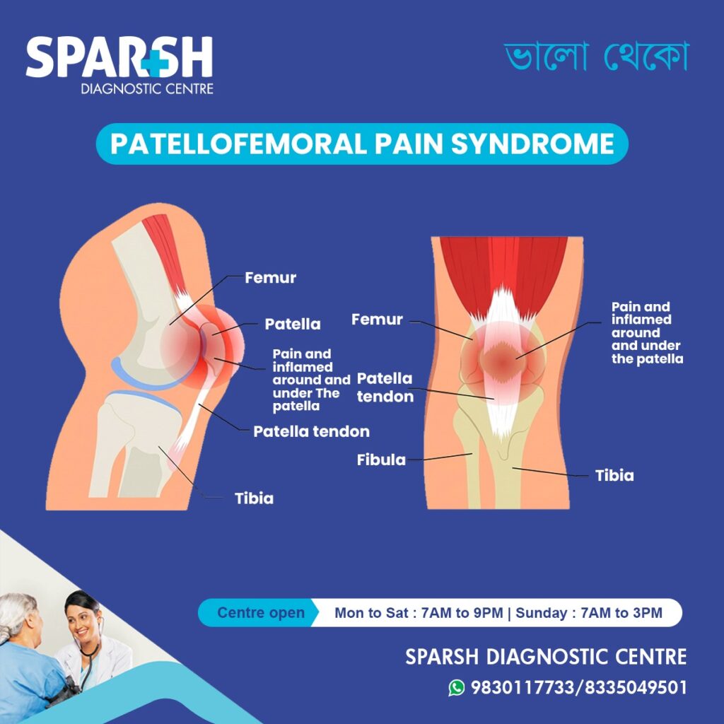Patellofemoral Pain Syndrome: Causes, Symptoms, Treatment, and ...