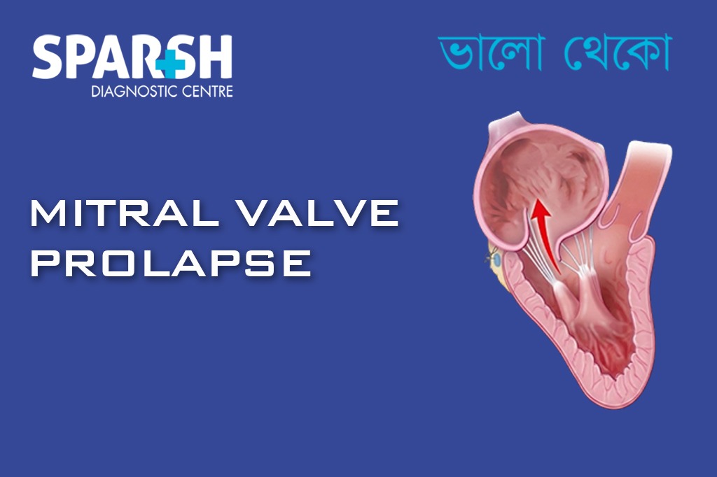 Mitral Valve Prolapse: Symptoms, Causes, Diagnosis, Treatment, and ...