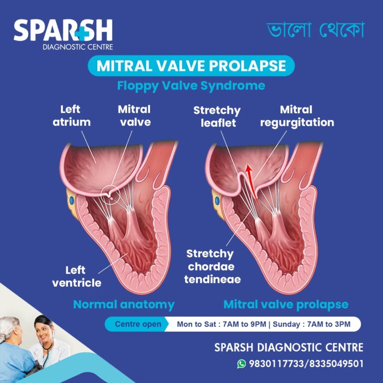 Mitral Valve Prolapse: Symptoms, Causes, Diagnosis, Treatment, and ...